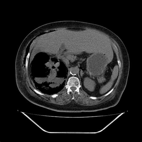 Emphysematous Pyelitis Pacs