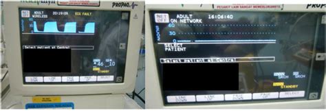 Quantitative Waveform Capnography Etco2 The Picture On The Left
