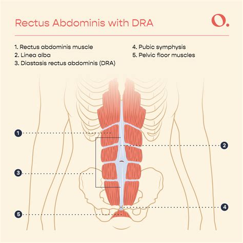 How To Prevent Diastasis Recti Origin