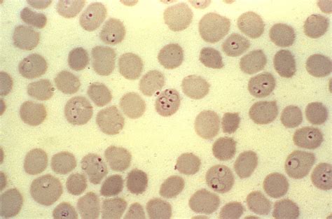 Imagen Gratis Micrografía Anillo La Forma El Plasmodium Falciparum