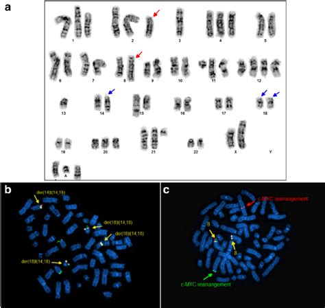 Conventional Cytogenetics And Fish Analysis Of Rc Cells A