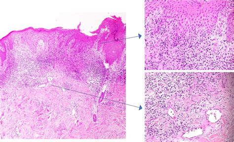 A Case Of Pyoderma Gangrenosum Around The Urethral Meatus Aggravated By Covid‐19 Infection And