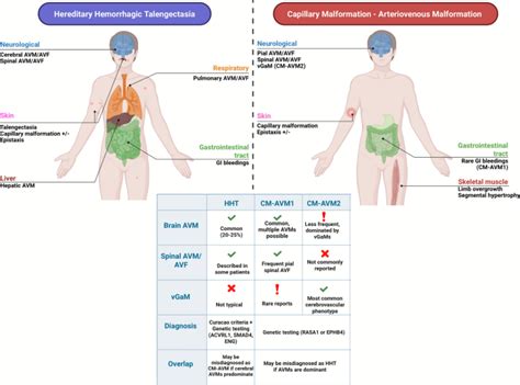 Capillary Malformation Arteriovenous Malformation Syndrome Cm Avm A
