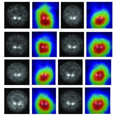 Dataset Of Datscan Spect Images Download Scientific Diagram