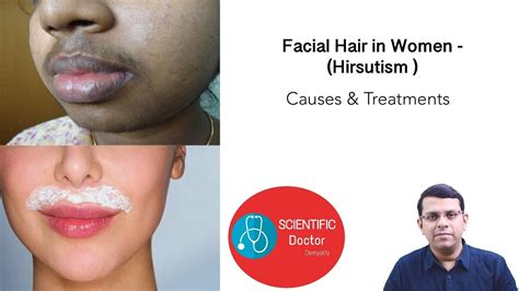Facial Hair In Women Hirsutism Causes And Treatments Youtube