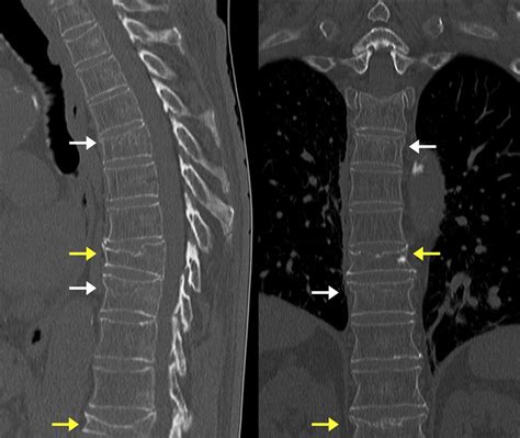 Acute And Chronic Vertebral Compression Fractures Radiology Case Radiopaedia Org Radiology