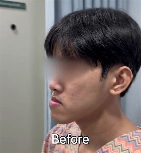 양악수술의 어마무시한 위력 ㄷㄷㄷ 자유게시판 라이브스코어 라이브맨 실시간 라이브스코어 토토사이트 추천 꽁머니 먹튀검증