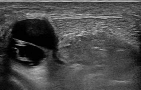 Musculoskeletal Joints And Tendons 66 Knee Case 6614 Meniscus