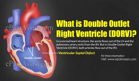 Double Outlet Right Ventricle Dorvcausessymptomstreatment