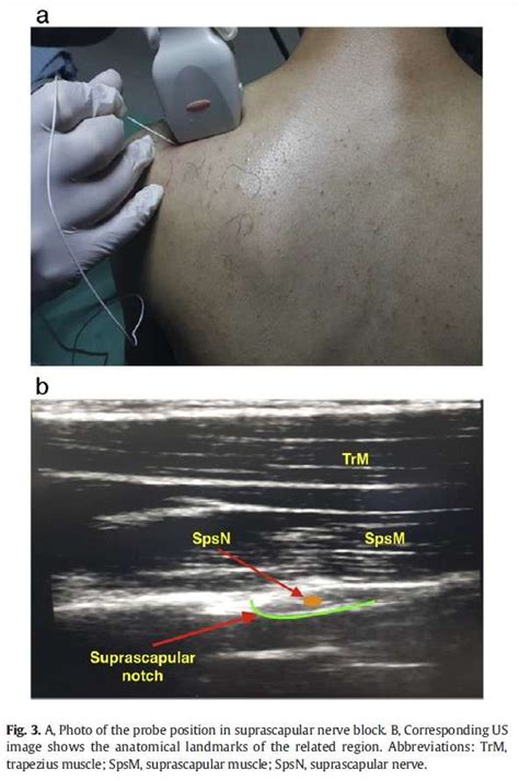 The Suprascapular Nerve Block Sports Medicine Review