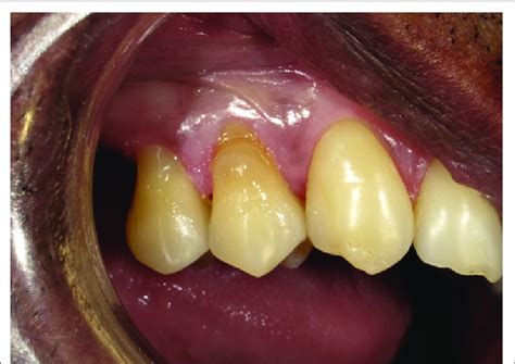 A Flowable Nanohybrid Composite Was Dispensed Into The Bonded Download Scientific Diagram
