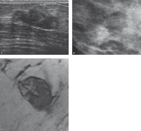 Imaging Of Breast Lesions Radiology Key