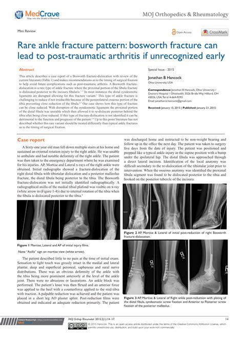 Rare Ankle Fracture Pattern Bosworth Fracture Can Lead To Post Rare Ankle Fracture Pattern Bosworth Fracture Can Lead To Post