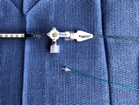 Three Way Stopcock Attached To 1 Ml Syringe And 3f Fogarty Arterial