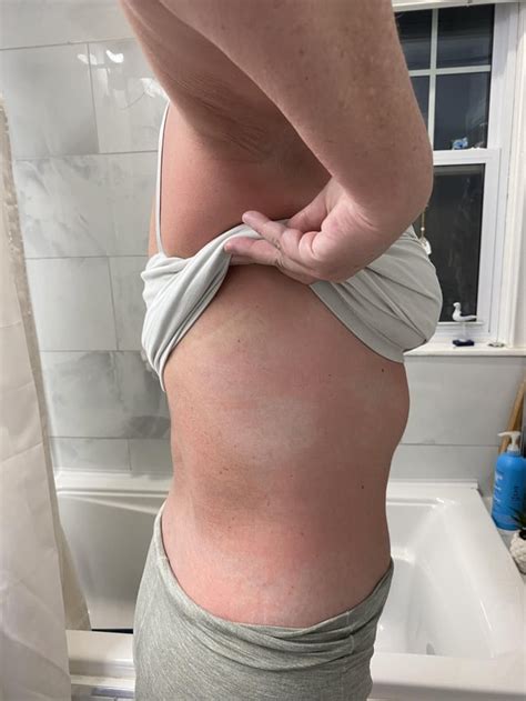 Used A Topical Flagyl Cream On My Face Only And This Happened Alllll Over Can A Reaction To