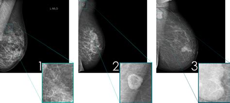 Figure 1 From Detecting Abnormal Axillary Lymph Nodes On Mammograms Using A Deep Convolutional