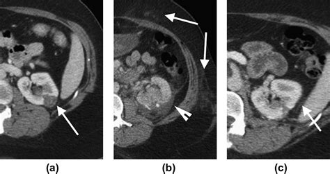 Making Sense Of Postoperative Ct Imaging Following Laparoscopic Partial Nephrectomy Clinical
