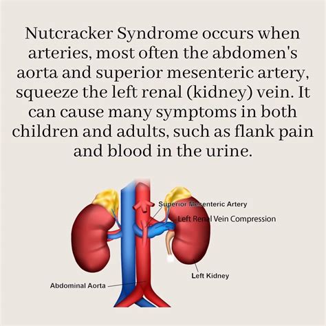 Nutcracker Syndrome Association