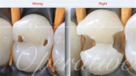 Class Iii Preparation Flashcards Quizlet