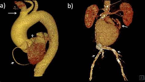 Imaging Aortic Aneurysmal Disease Heart