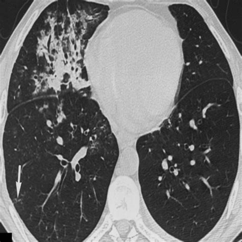 Lung Object Detection Dataset And Pre Trained Model By YOLO