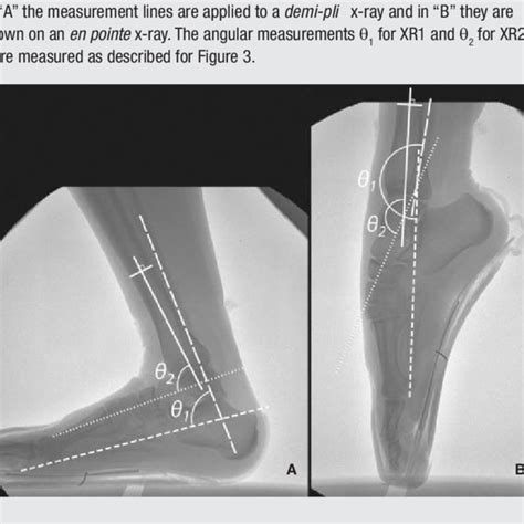 Pdf Is Goniometry Suitable For Measuring Ankle Range Of Motion In Female Ballet Dancers An