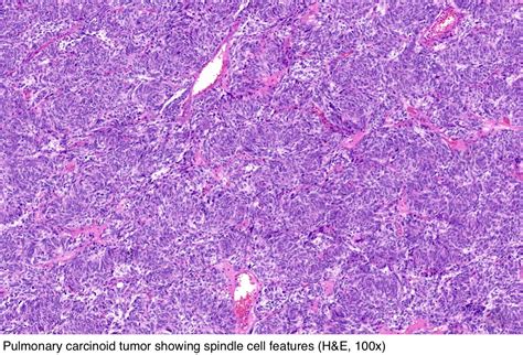 Spindle Cell In Lung At George Jefferson Blog