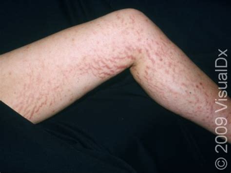 Is It Normal To Have Stretch Marks On Thighs