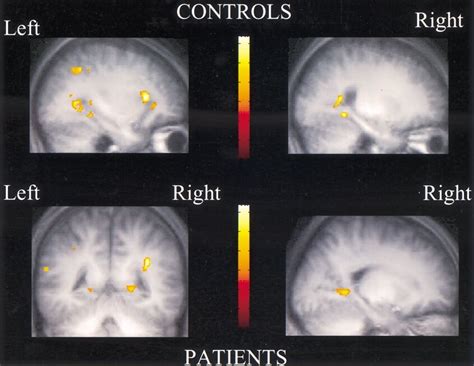 Mean Parahippocampal Activations During The Retrieval Task In Control Download Scientific