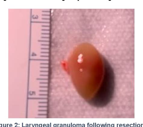 Figure 2 From Laryngeal Granuloma Formation Following Endotracheal