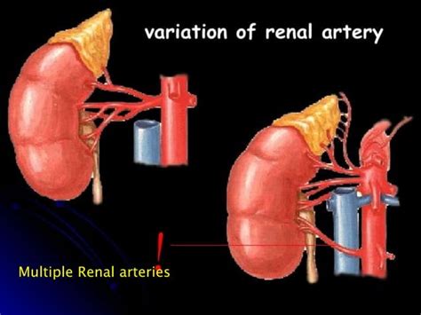 Renal Artery Variation In Renal Transplantation Pptx Surgery
