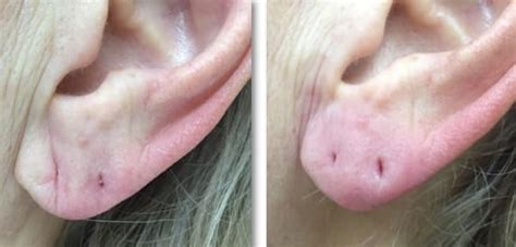 Earlobe Rejuvenation Near Me Ear Filler Aventura And Hollywood