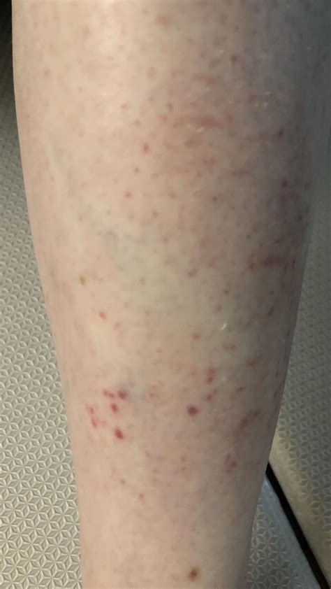 Redness On Shins Rmedicaladvice
