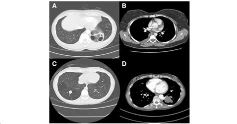 A Pulmonary Sequestration Intralobar Presenting As A Multi Cystic Download Scientific