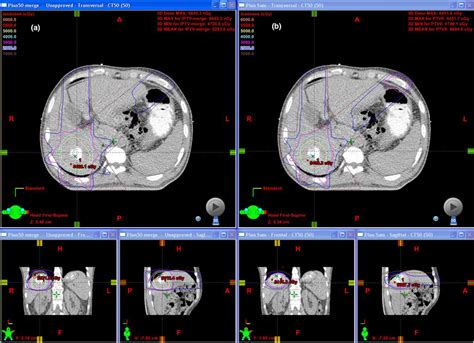 An Example Of The Dose Distribution A Three‐dimensional 3d Dose