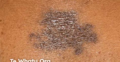 Lichenoid Keratosis Image