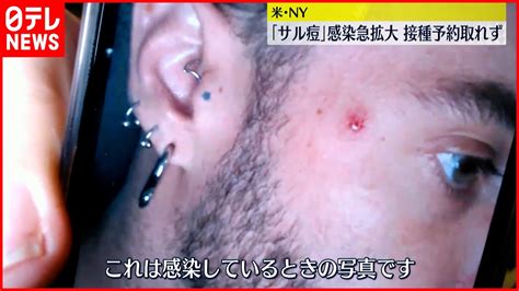 【サル痘】患者がじわり増加‼ レンレンのとりざた速報