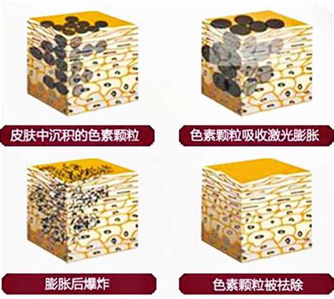 老年斑 上海时光整形外科医院官网