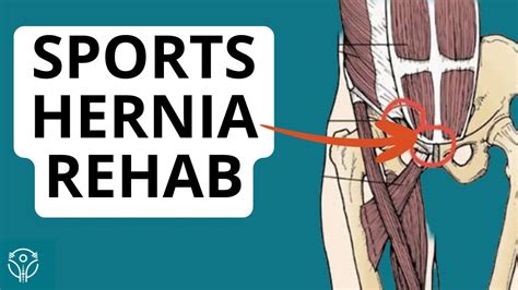 Sports Hernia Pain Sitting At Kathleen Flores Blog
