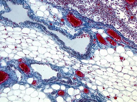 Lymph Node Human LM Stock Image C Science Photo Library