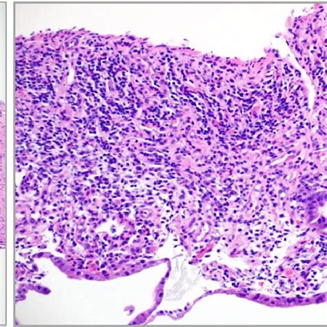 Distal Duodenum Biopsy With Hematoxylin And Eosin Hande Stain × 10 Left Download Scientific