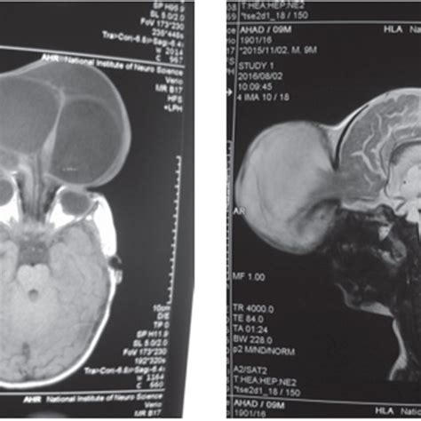 Mri Of Brain Showing Encephalomeningocele Figure Vii Mri Of Brain