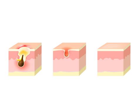 伤口感染用什么药水好 39就医助手