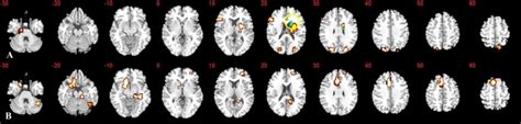 Whole Brain Correlation Of Activation With Age Clusters Exhibiting