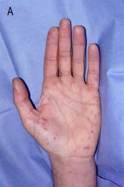 Erythematous Macular Non Blanching Skin Rash Download Scientific Diagram