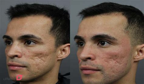 لیزر جای جوش تعداد جلسات هزینه عوارض عکس قبل و بعد