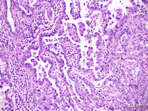 Pathology Outlines Clear Cell Carcinoma