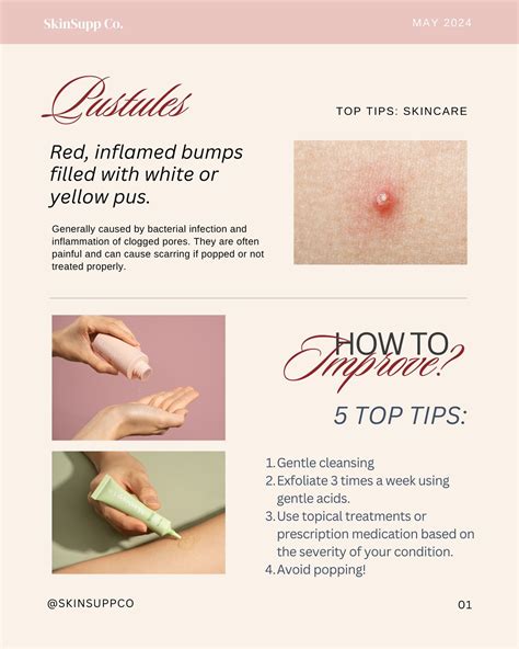 Best 12 Milia Causes And Treatment Artofit