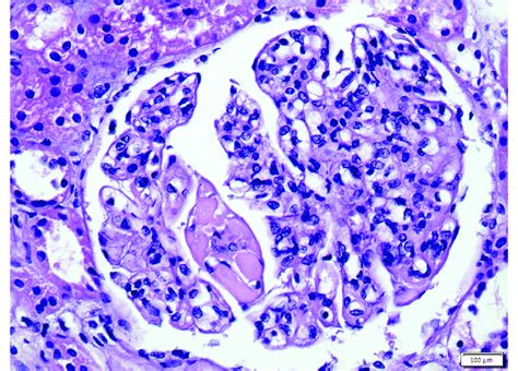 Mesangial And Endocapillary Cellularityproliferation In Association