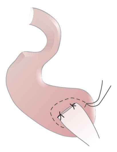 A Diagram Showing Steps Of The Procedure A A Purse String Is Download Scientific Diagram